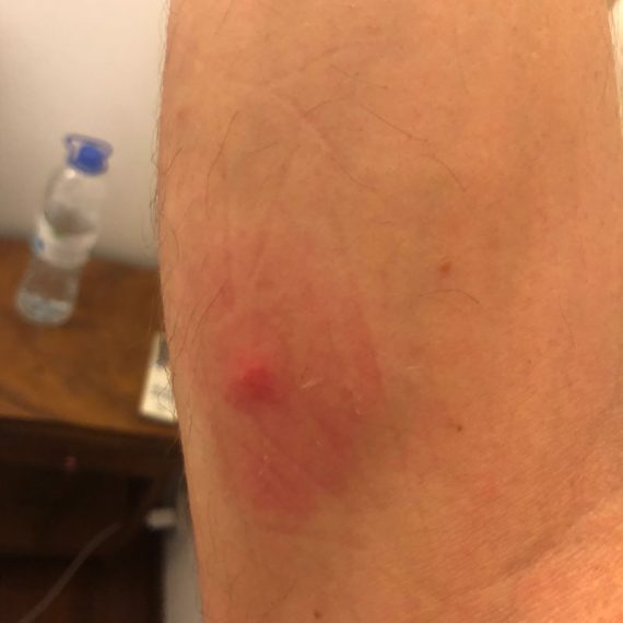 How to spot sandflies and biological facts - Sandflybites