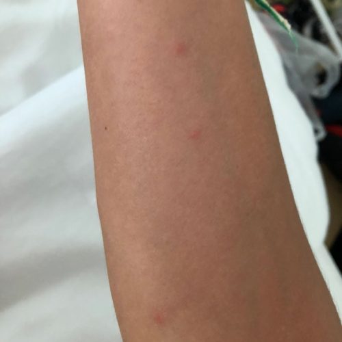 Sandflies Thailand: All Information and tips about sandfly bites in ...