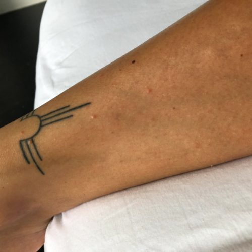 How long do sand fly bites last? Typical stages of sandfly bites ...