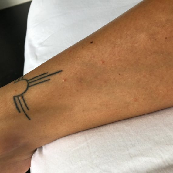 How long do sand fly bites last? Typical stages of sandfly bites ...