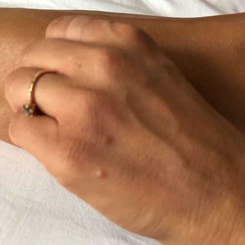 Sandflies in Australia (Midges and Sandfly) - Sandflybites